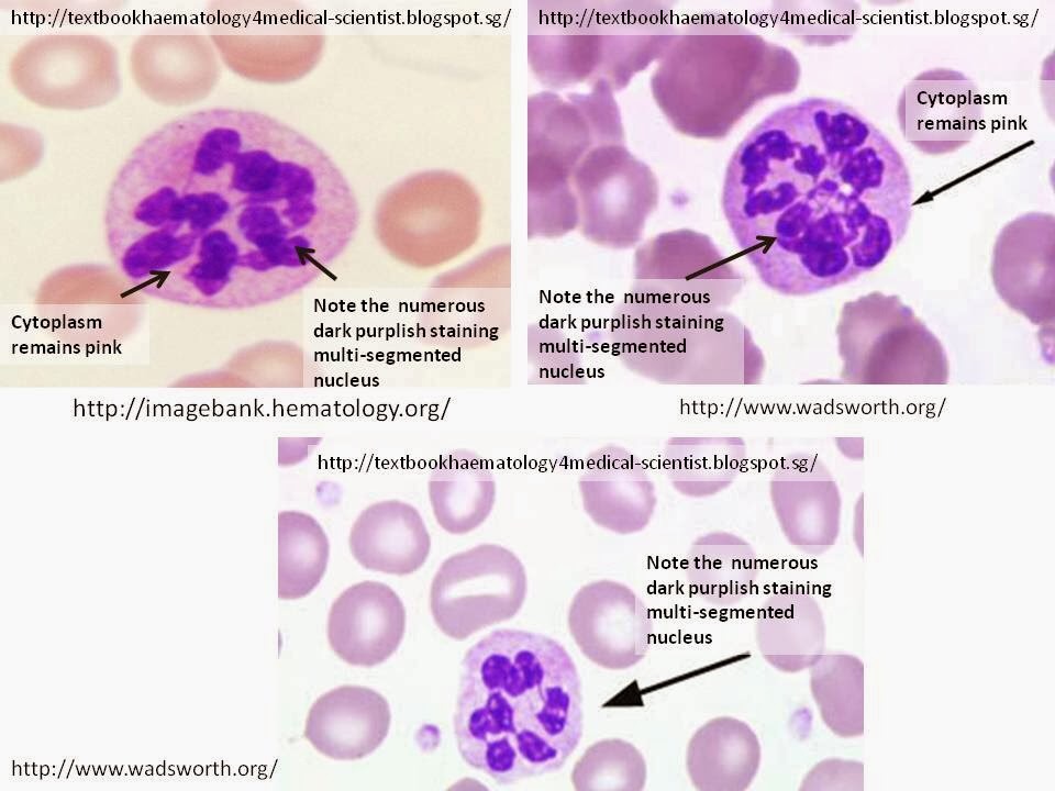 Usmle Step 1 Presence Of Hypersegmented Neutrophils Have